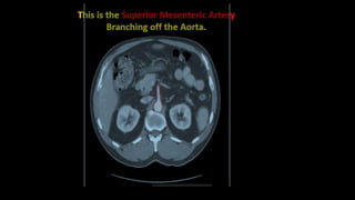 Abdominal CT scan, Triphasic CT scan, Abdominal Anatomy and ...