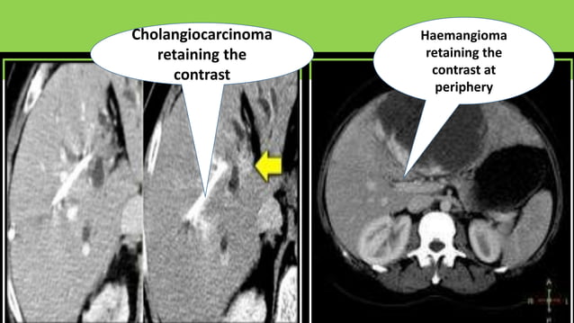 Abdominal Ct Scan Triphasic Ct Scan Abdominal Anatomy And