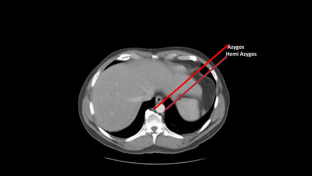 Abdominal Ct Scan Triphasic Ct Scan Abdominal Anatomy And