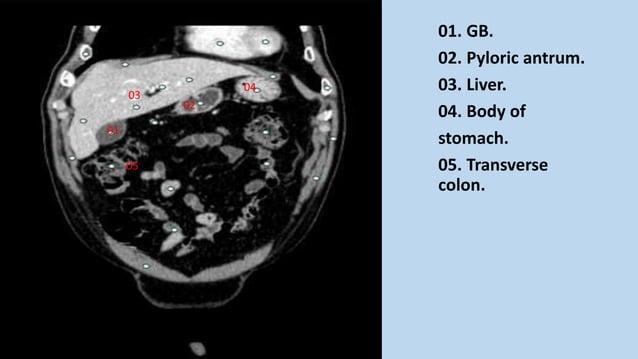 Abdominal Ct Scan Triphasic Ct Scan Abdominal Anatomy And