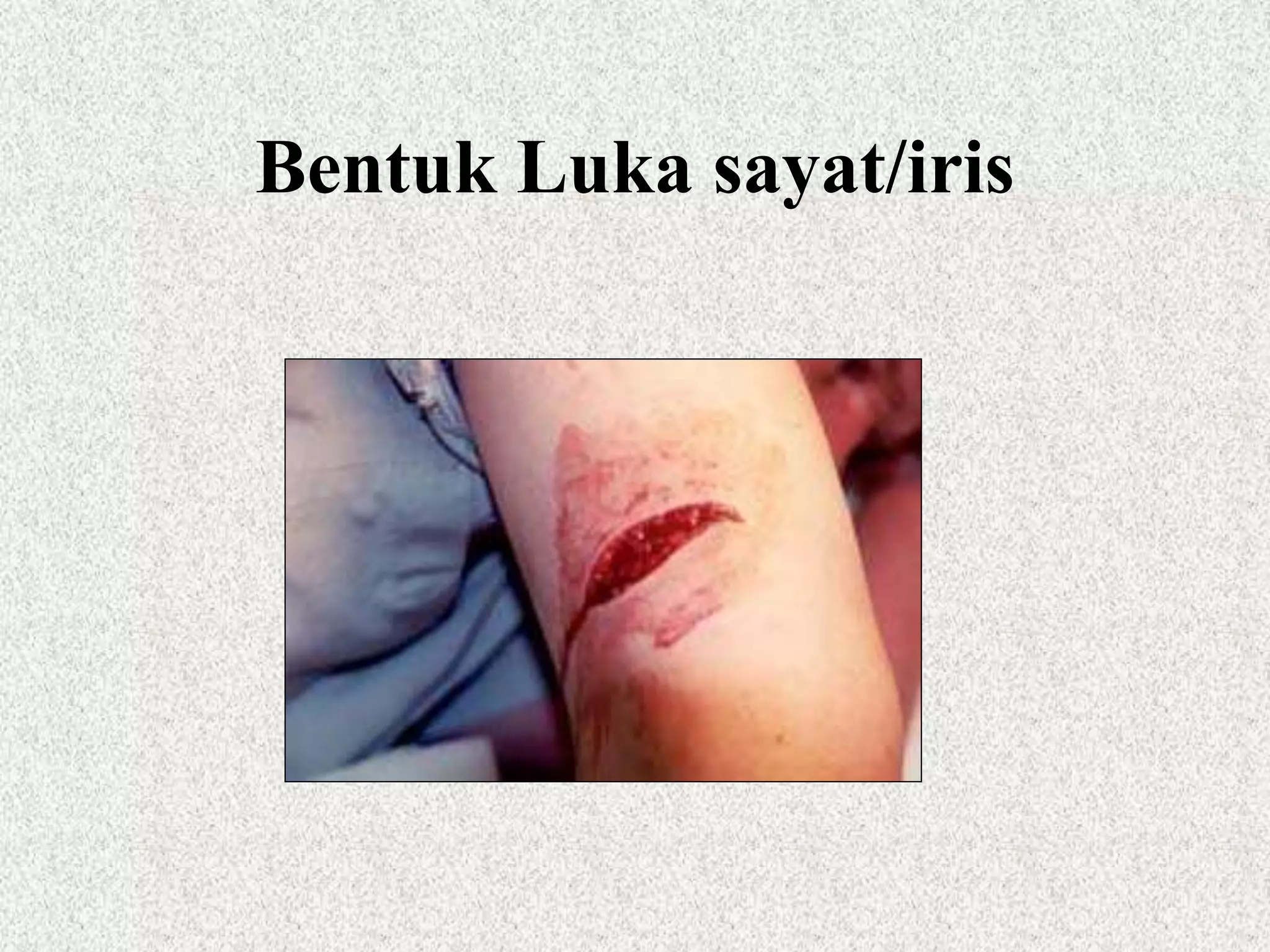 Cedera jaringan lunak | PPT