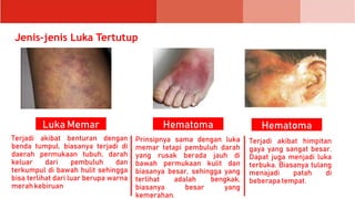 cedera jaringan lunak.pptx