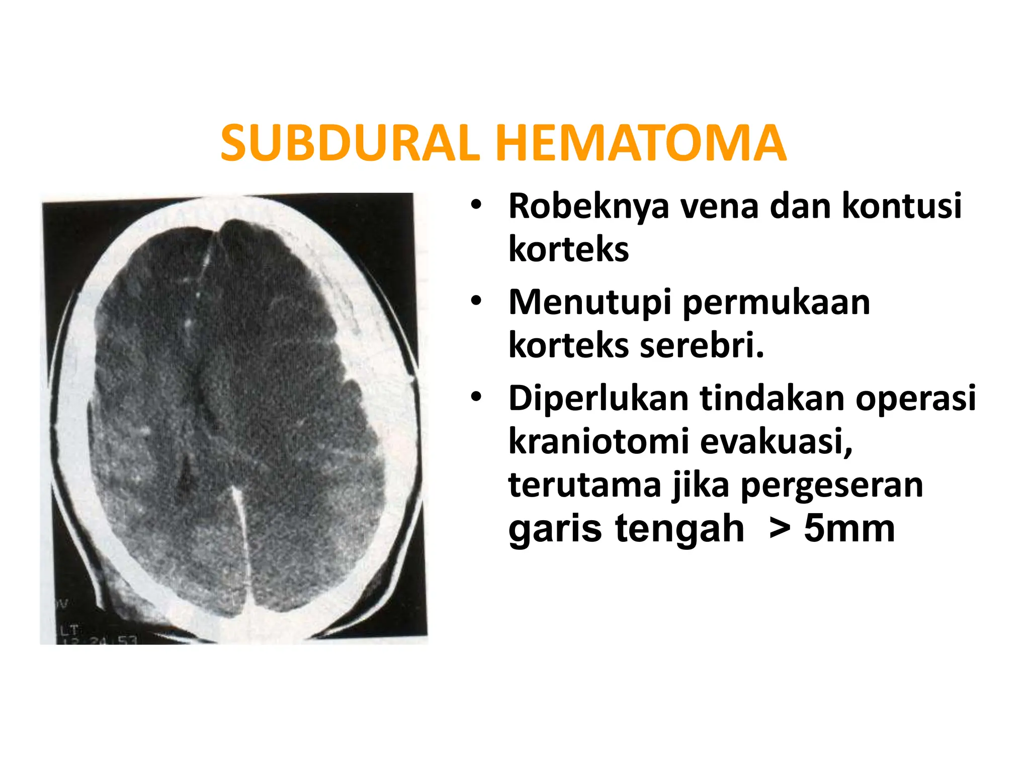 cedera kepala macam macam dan tatalaksana.pptx