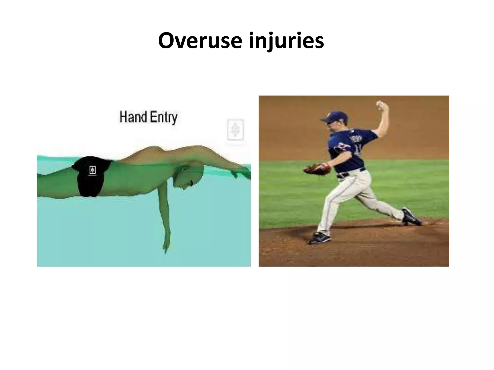 Overuse injurues in overhead athletes 3 | PPTX