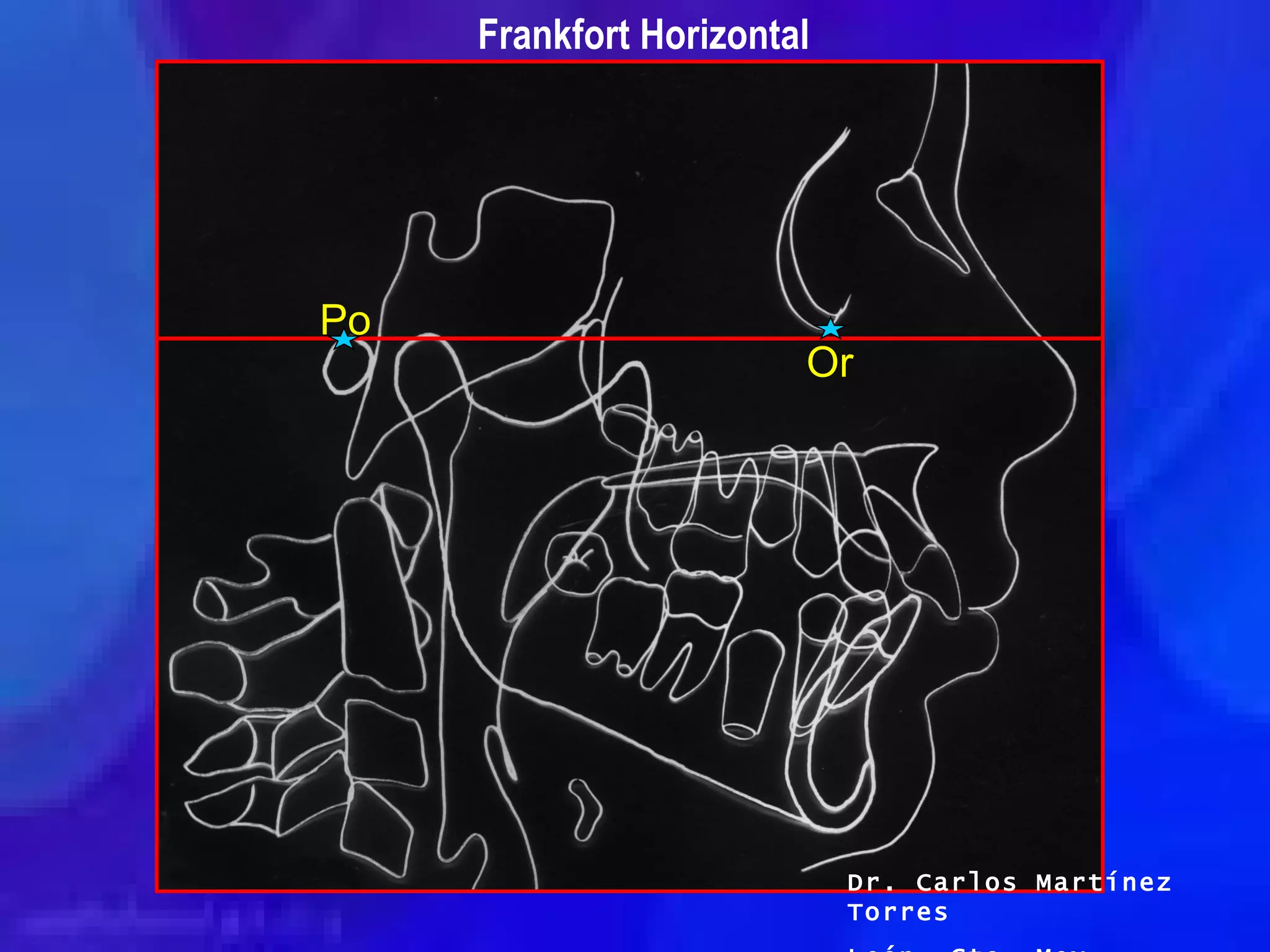 Cefalometria De Ricketts Lateral Ppt