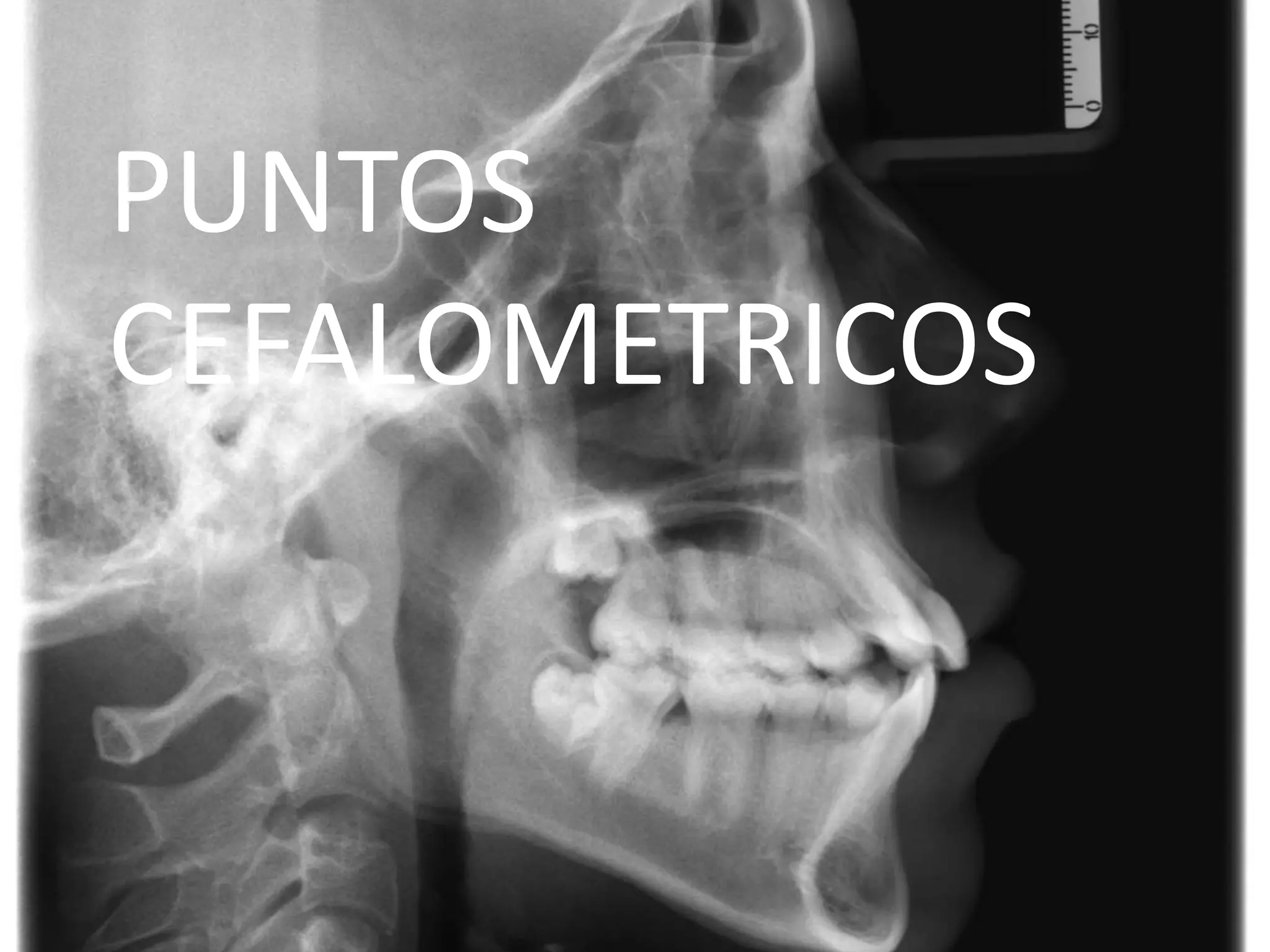 Cefalometria dr. huete 004 | PPTX