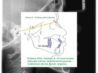 Cefalometria dr. huete 011 | PPTX