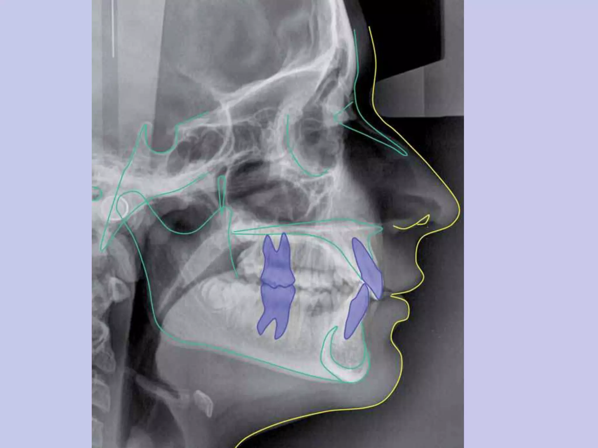 Cefalometria puntos y planos | PPTX