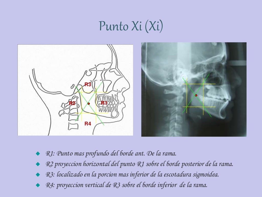 Cefalometria puntos y planos