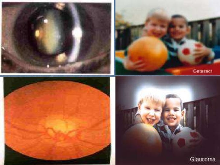 CEGUERA Y BAJA VISIÒN