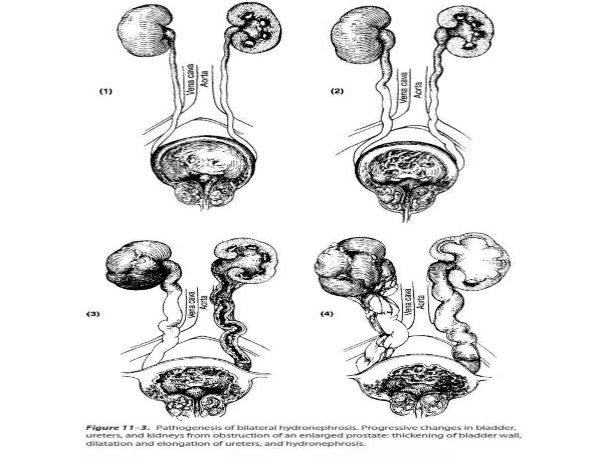 Urinary Tract Obstruction | PPTX