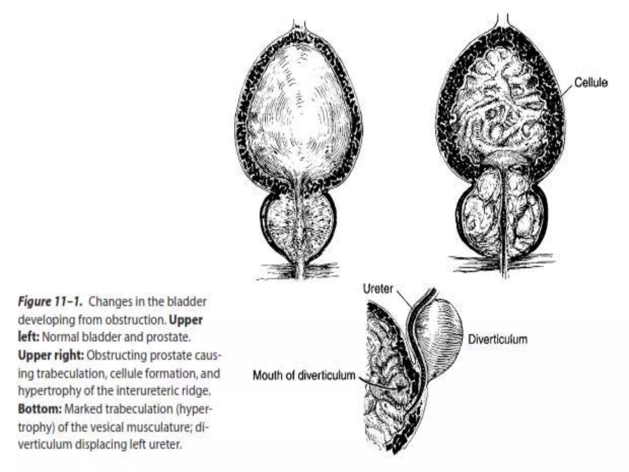 Urinary Tract Obstruction | PPTX
