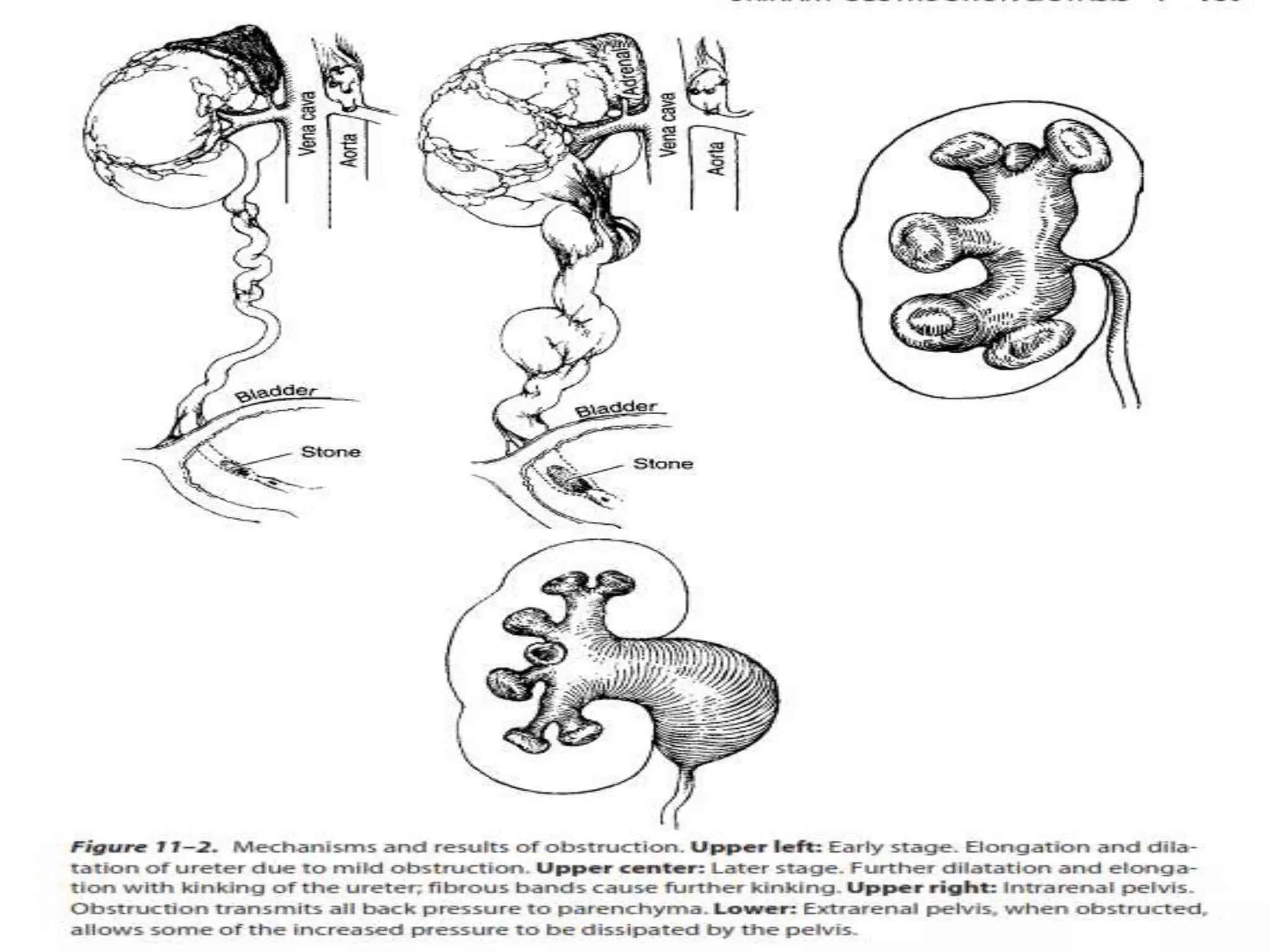 Urinary Tract Obstruction | PPTX