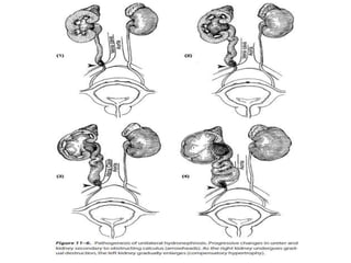 Urinary Tract Obstruction | PPTX