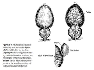 Urinary Tract Obstruction | PPTX