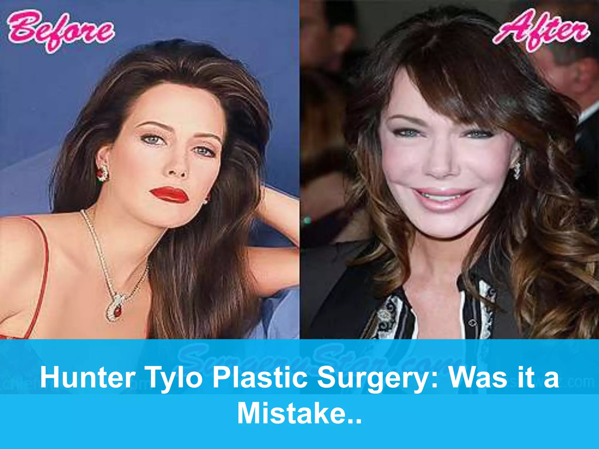 Celebrity plastic surgery before and after | PPTX
