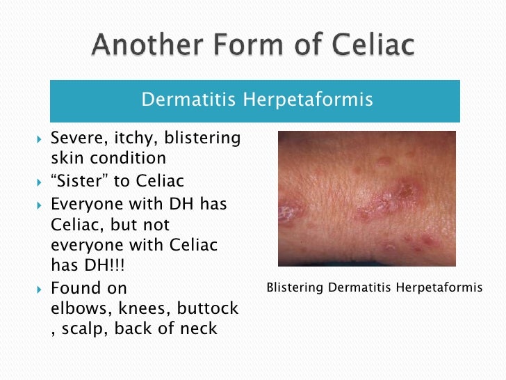 Celiac Disease