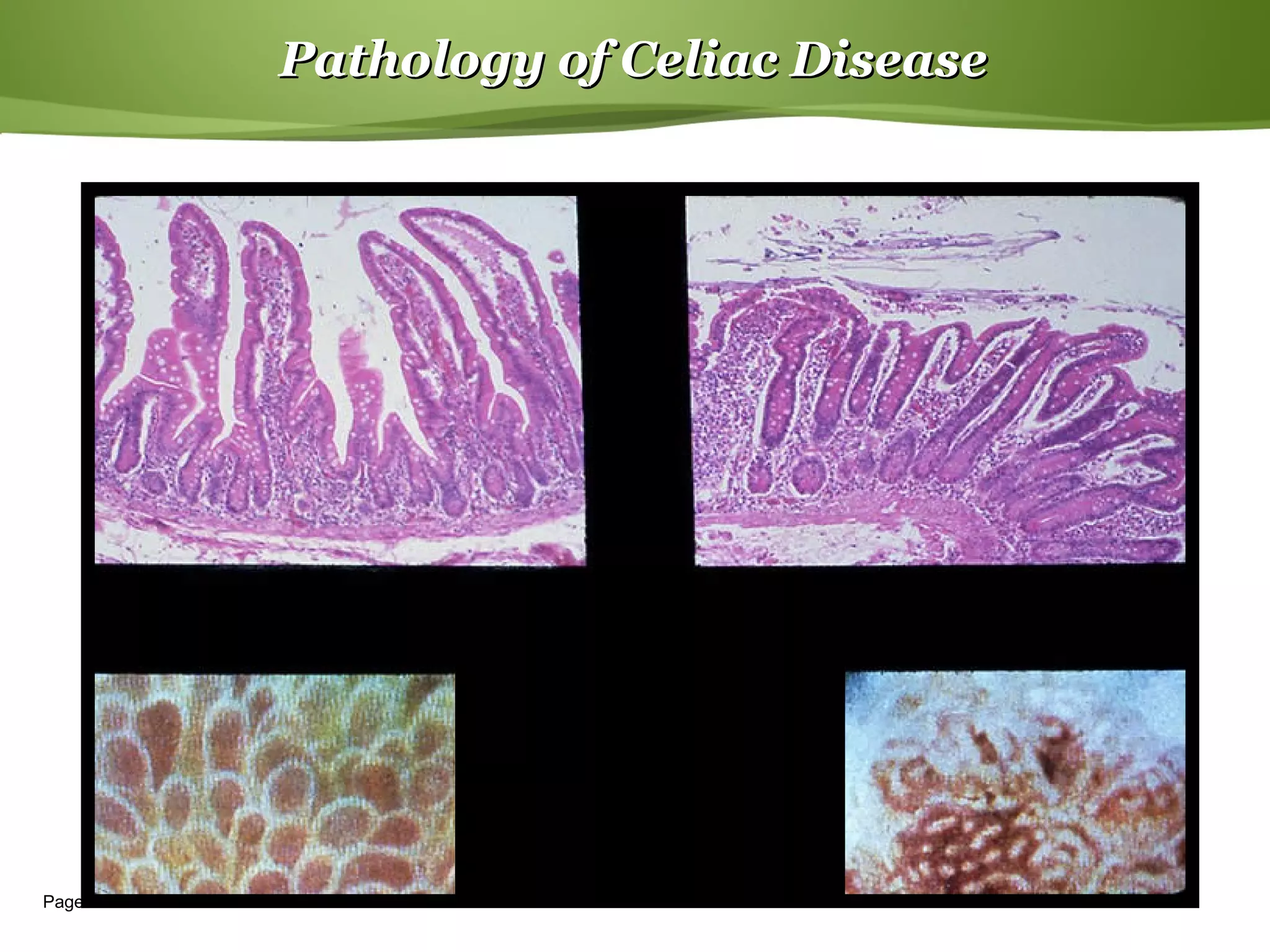 Celiac disease | PPT