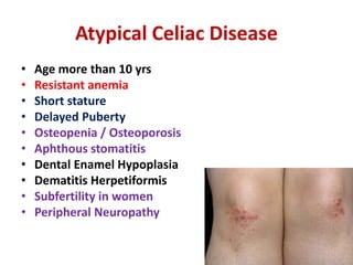 Celiac disease 2020 | PPTX