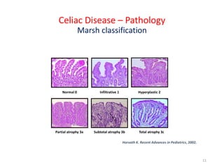 Celiac disease in children 2021 | PPT