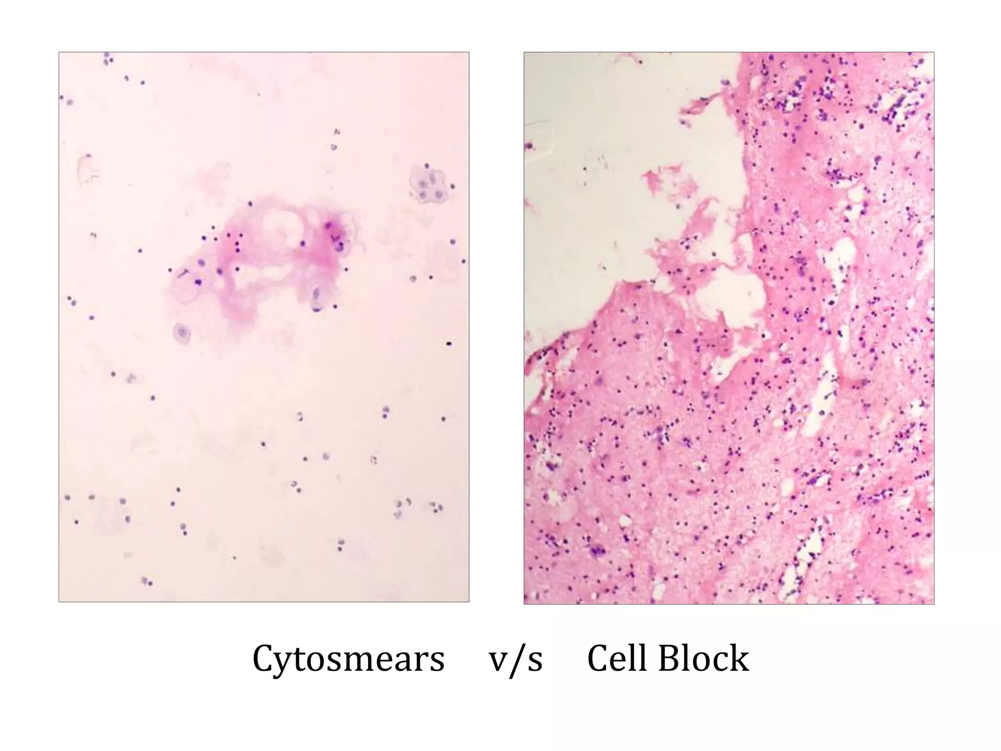 Cell block and its diagnostic utility | PPTX