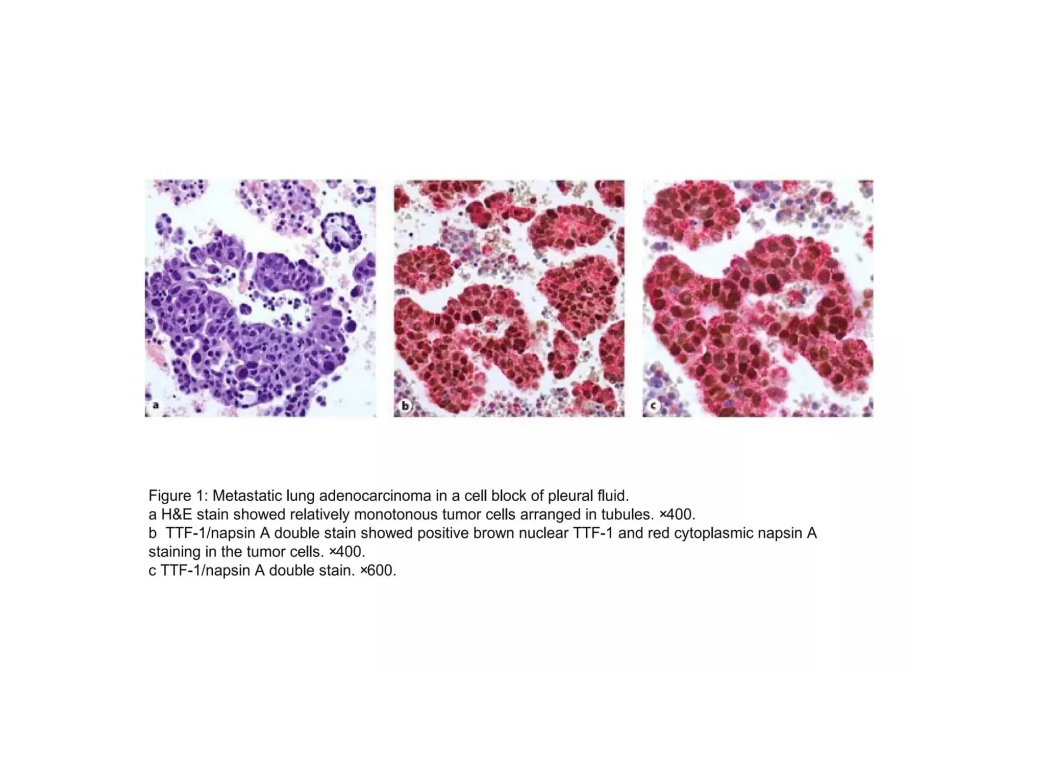 CELL BLOCK and its diagnostic utility in histopathology | PPTX