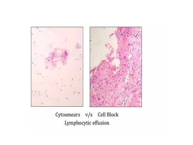 CELL BLOCK and its diagnostic utility in histopathology | PPT
