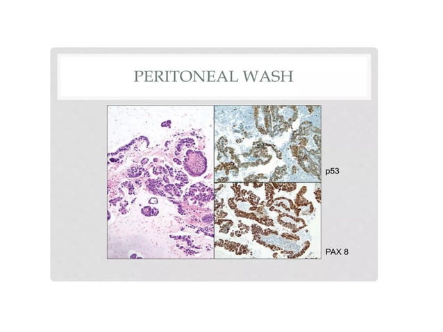 CELL BLOCK and its diagnostic utility in histopathology | PPT