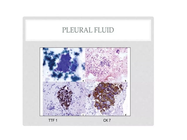 CELL BLOCK and its diagnostic utility in histopathology | PPT