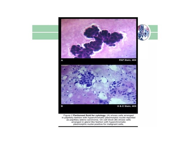 CELL BLOCK and its diagnostic utility in histopathology | PPT
