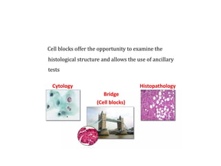 CELL BLOCK and its diagnostic utility in histopathology | PPT