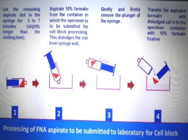 Cell block and liquid based cytology | PPTX