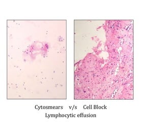 Cell block in cytology | PPT