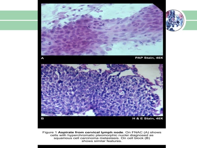 Cell block in cytology | PPT