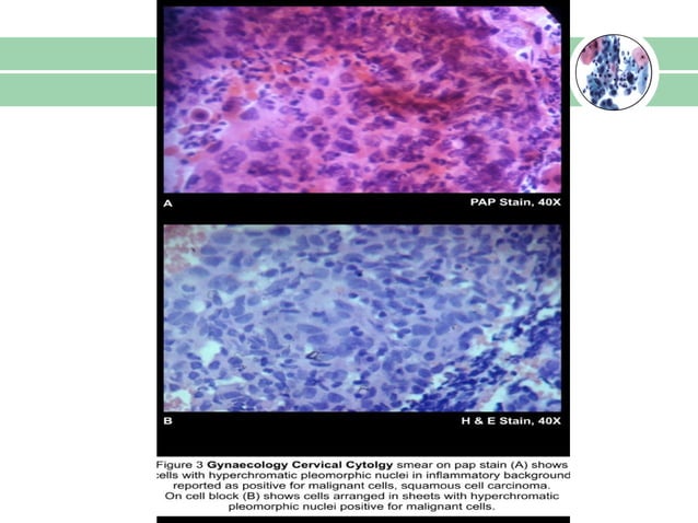 Cell block in cytology | PPT