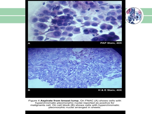Cell block in cytology | PPT