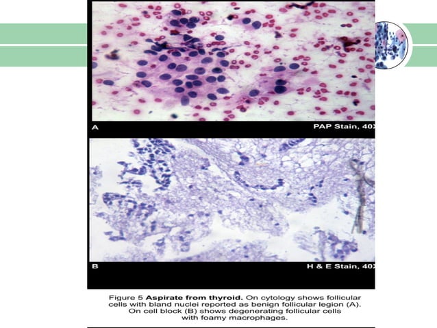 Cell block in cytology | PPT