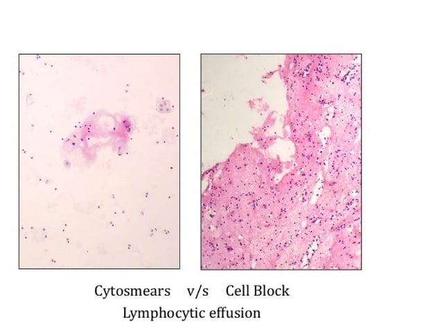 Cell block in cytology