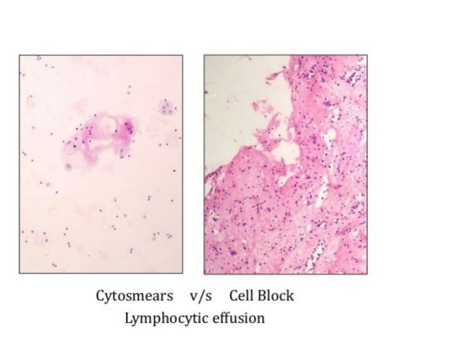 Cell block in cytology