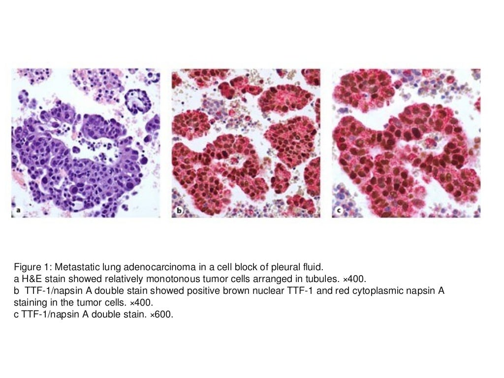 Cell block in cytology
