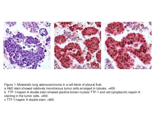 Cell block in cytology