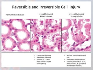 CELL INJURY (Reversible OR Irreversible Cell Injury | PPTX