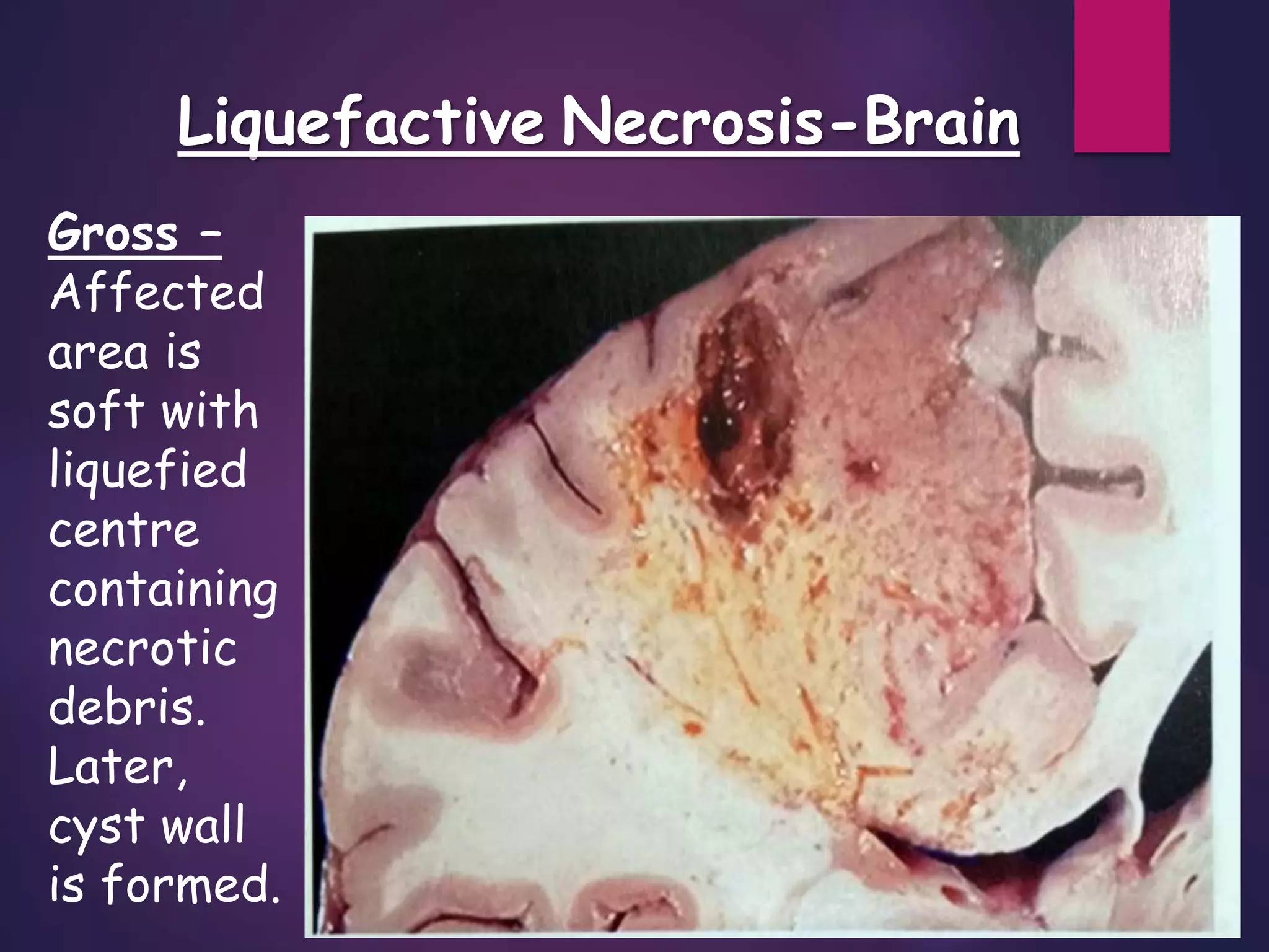 Cell injury-I Overview of cellular necrosis | PPTX