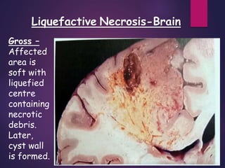Cell injury-I Overview of cellular necrosis | PPTX