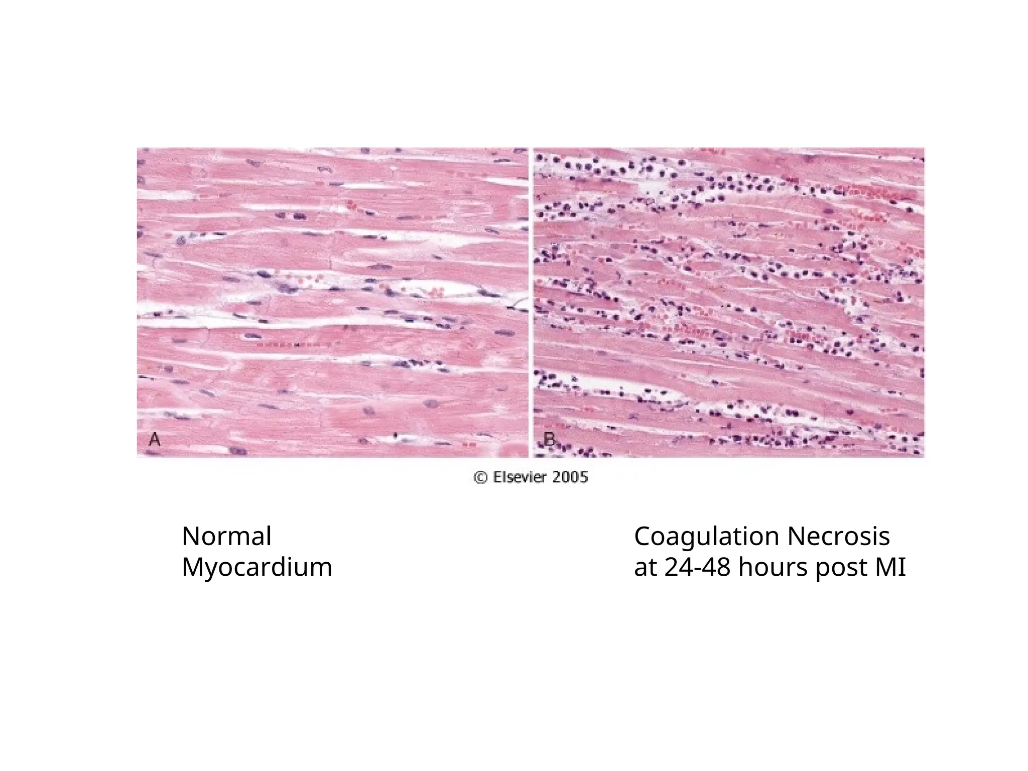 Cell injury-necrosis.ppt,types of necrosis, morphology | PPT