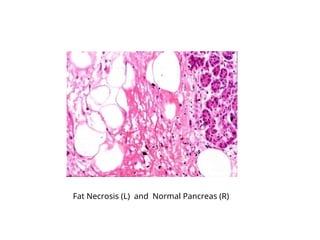 Cell injury-necrosis.ppt,types of necrosis, morphology | PPT