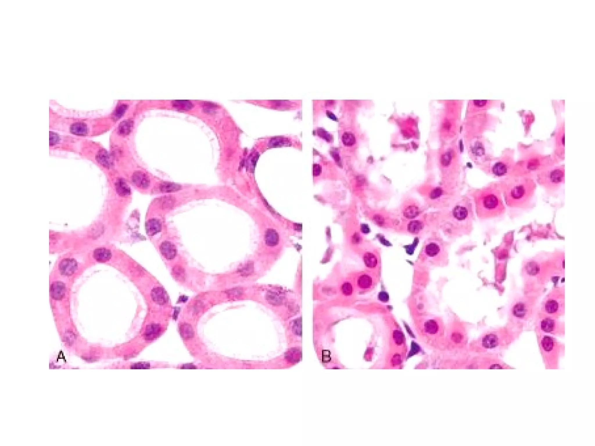 Cell injury: causes, pathogenesis, Morphology of reversible cell injury ...
