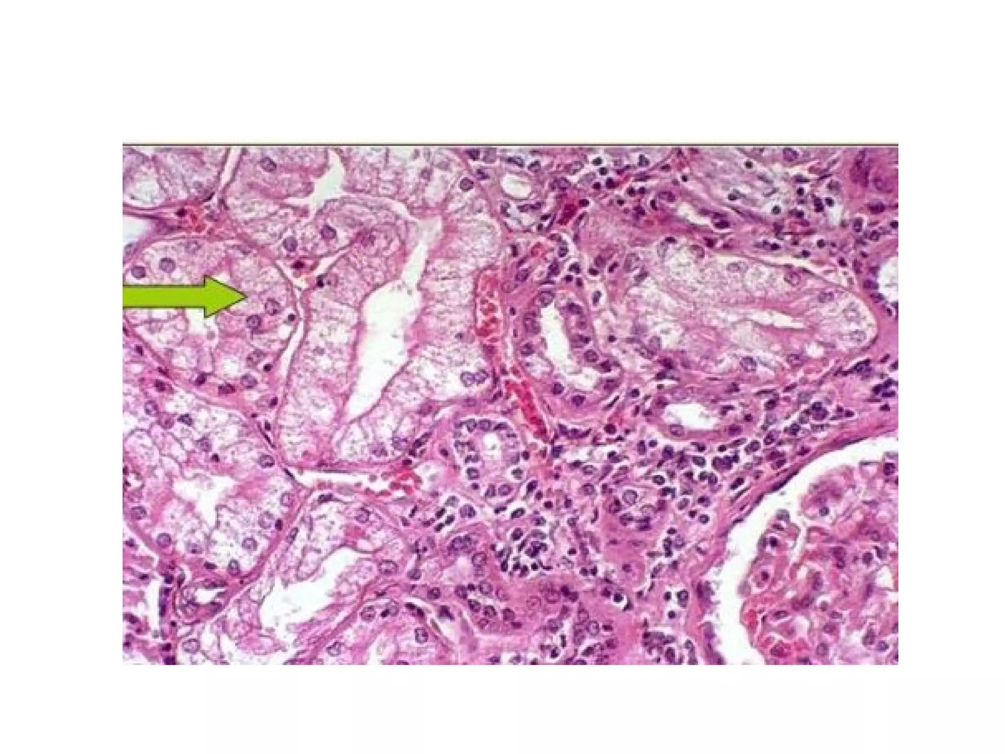 Cell injury: causes, pathogenesis, Morphology of reversible cell injury ...