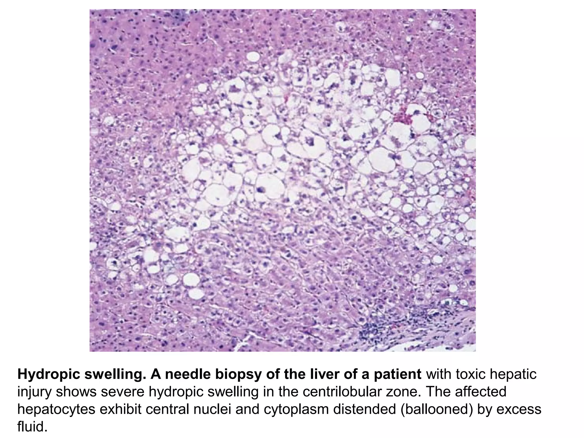 Cell injury: causes, pathogenesis, Morphology of reversible cell injury ...