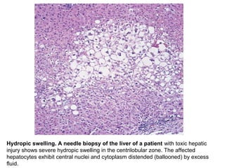 Cell injury: causes, pathogenesis, Morphology of reversible cell injury ...